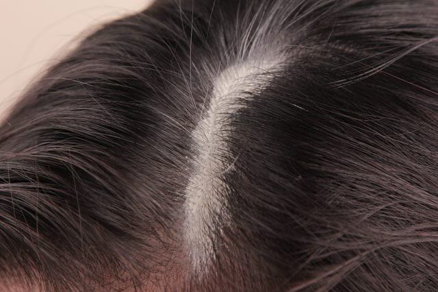 Sebum Scalp Build Up