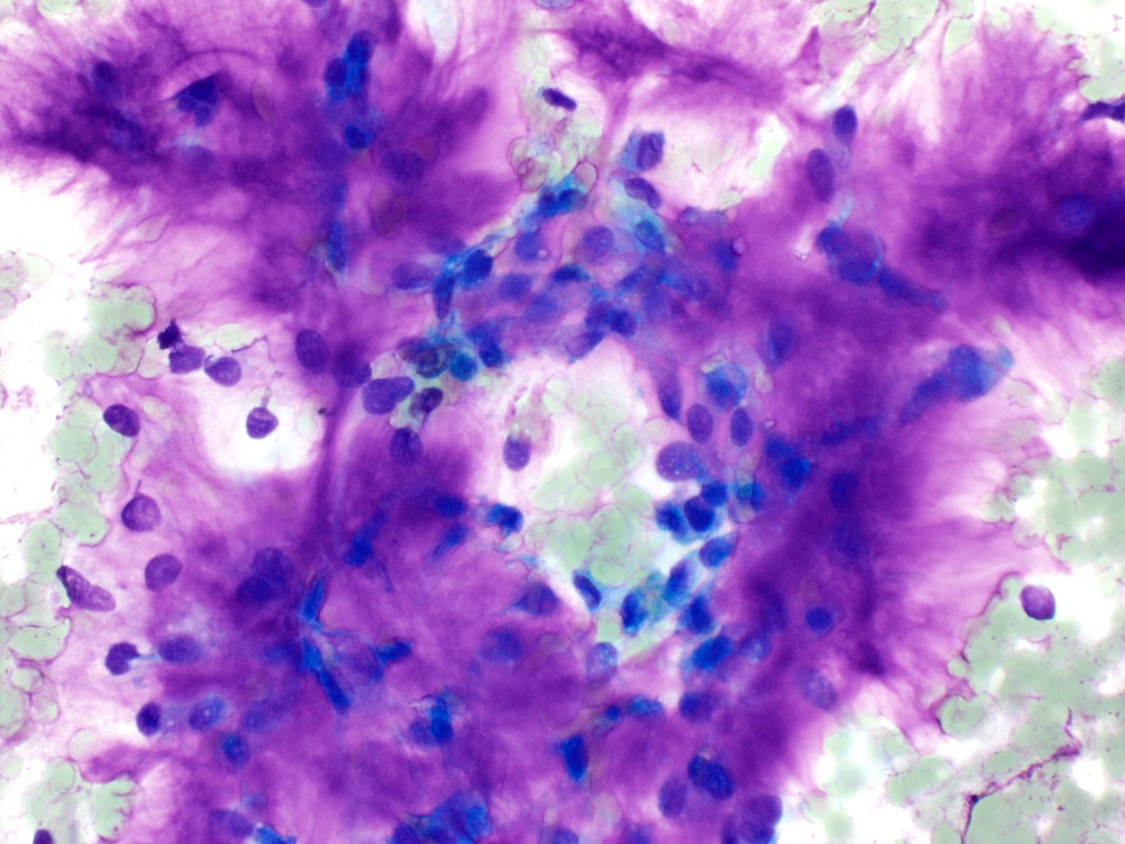 Pleomorphic Adenoma Cytology Salivary Glands (Chapter 10)