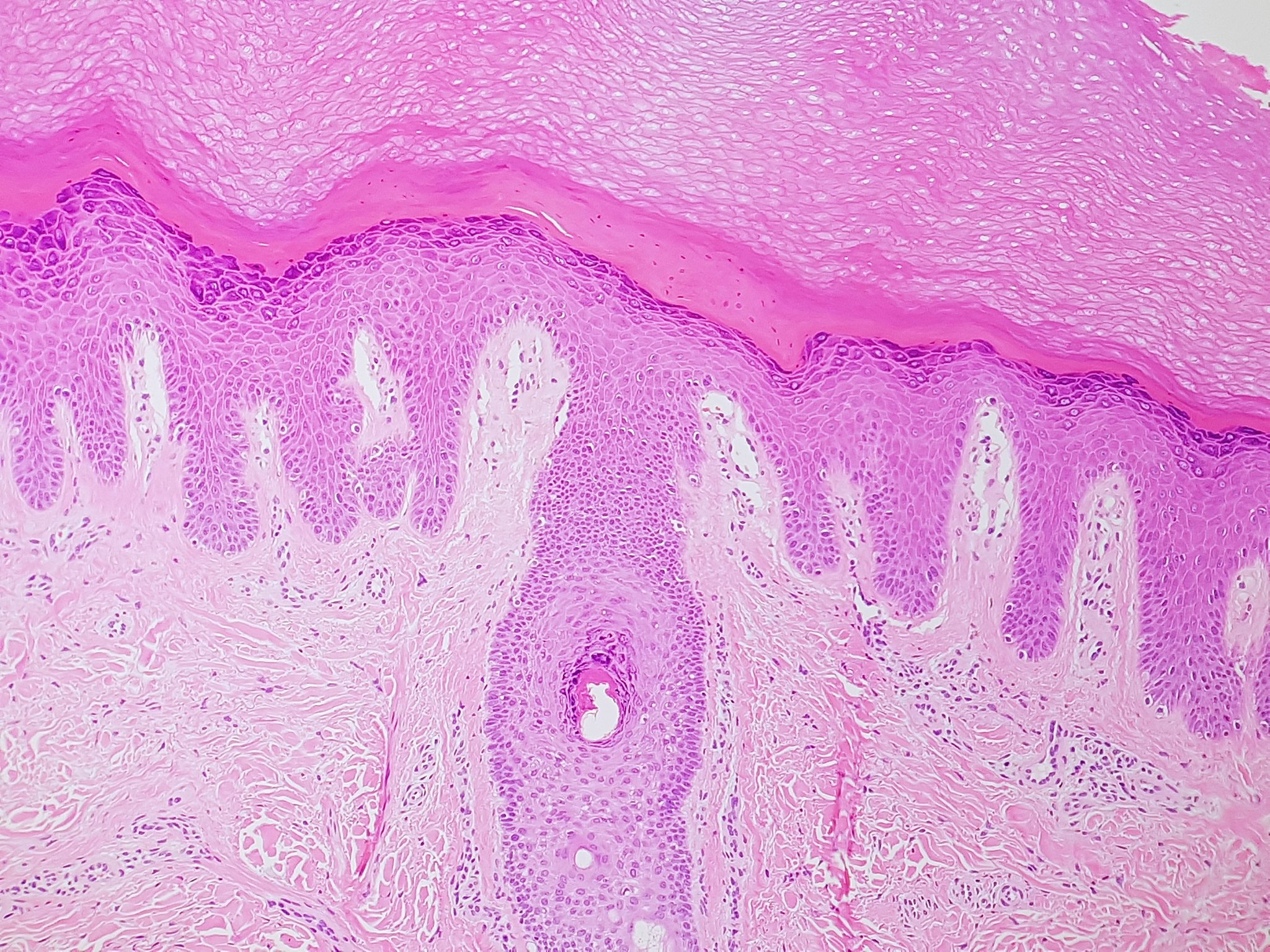Lichen Simplex Chronicus Histology