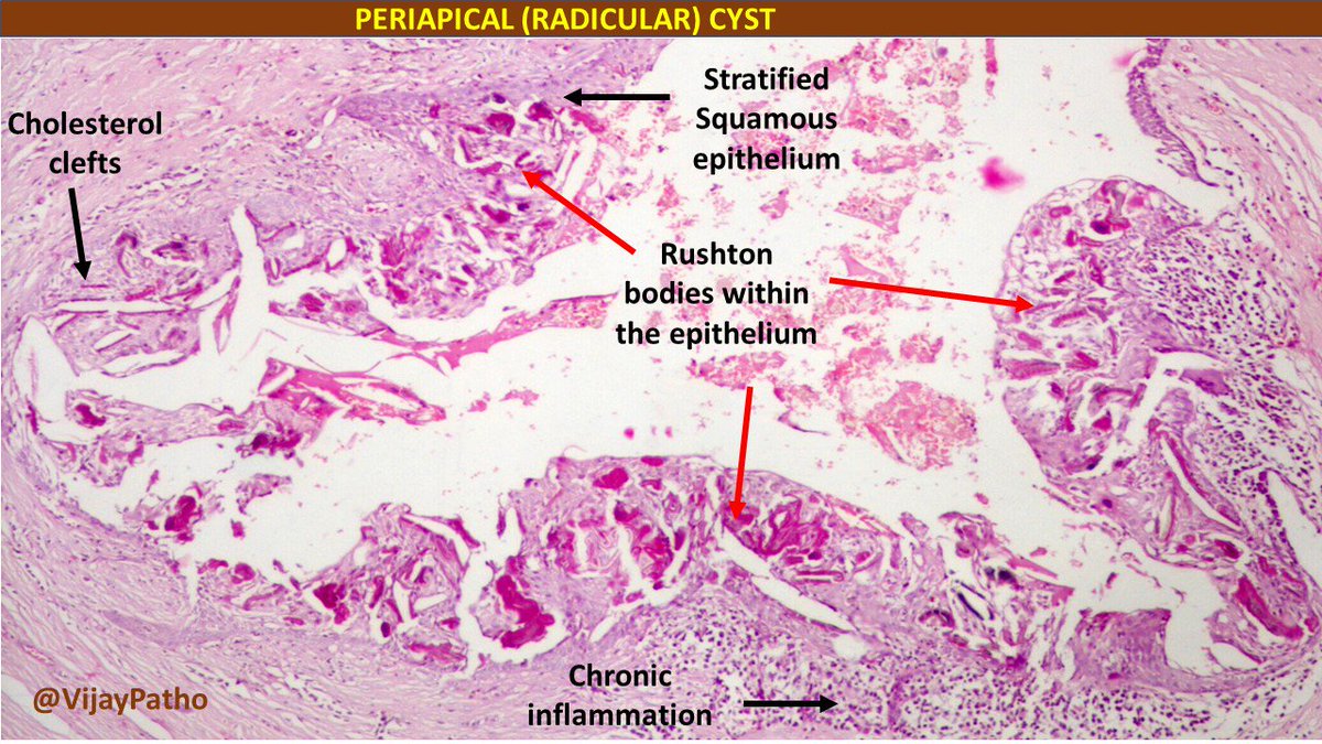 Periapical Cyst Histology