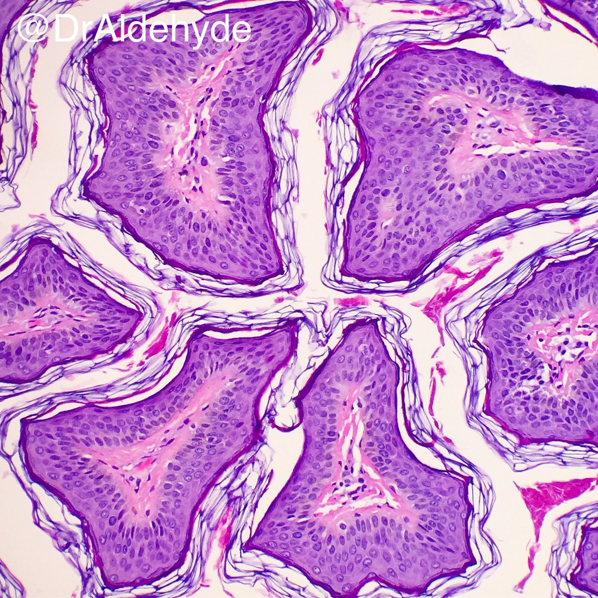 Acrochordon Histology