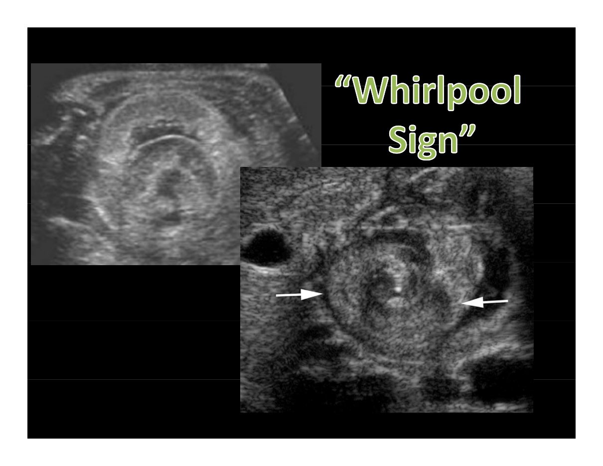 Volvulus Ultrasound