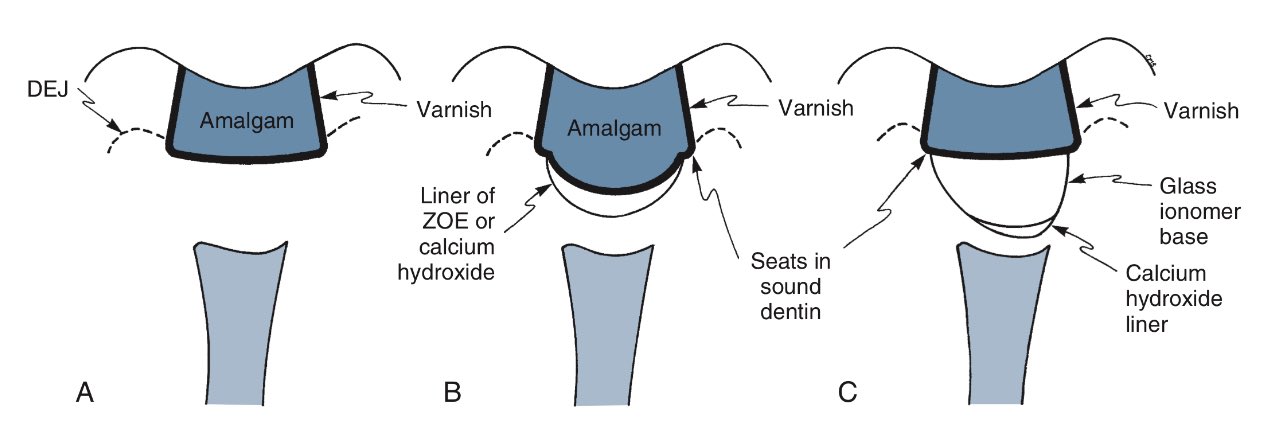 Cavity Preparation For Amalgam Restoration A Simple Way To Replace The