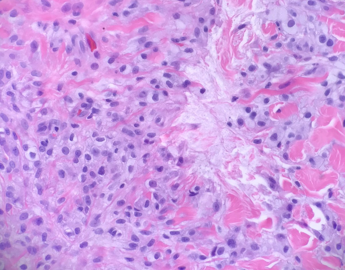 Differential Diagnosis Eruptive Xanthoma at Loretta Little blog