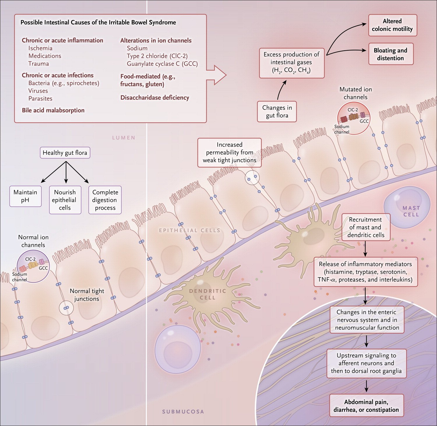 Irritable Bowel Syndrome Pathophysiology