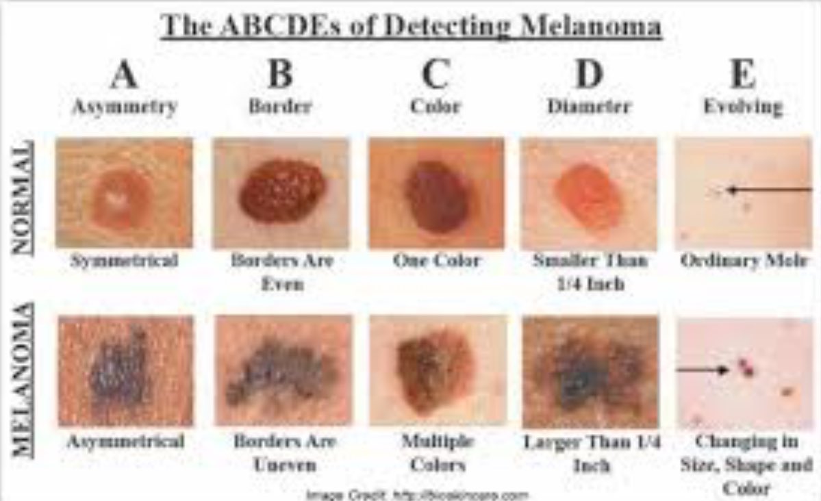 Seborrheic Keratosis Vs Melanoma