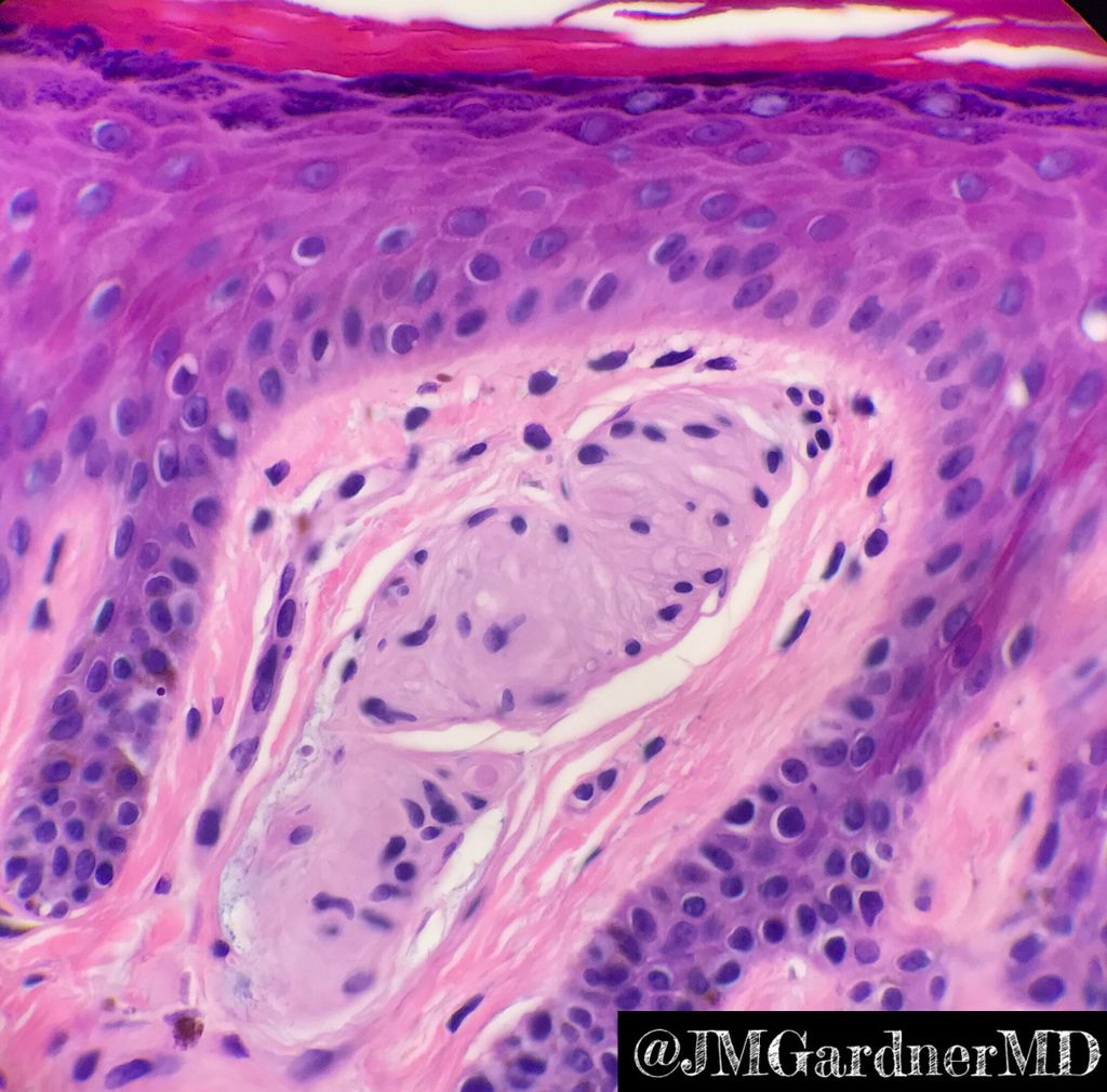 Meissner Corpuscle
