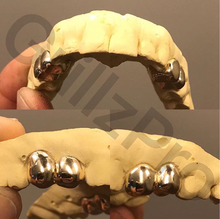 Gold Tooth Cap Molar