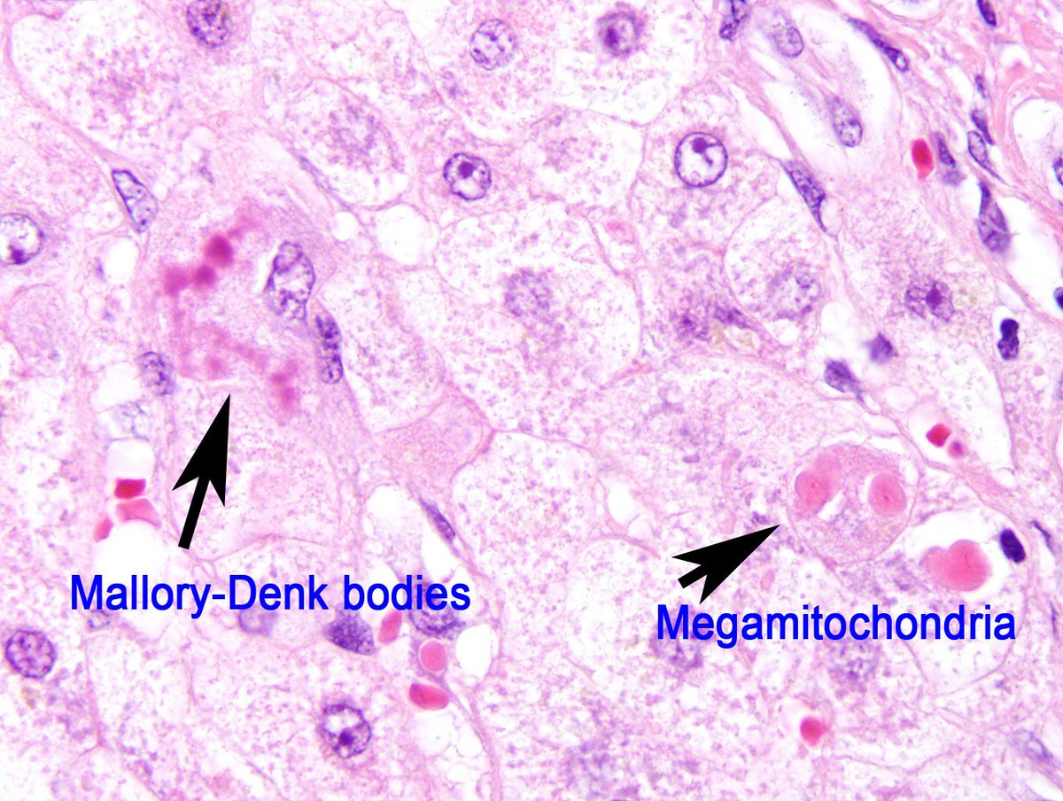 LIVER DISEASES (Normal Anatomy and Physiology (NOTES liver lobules have…