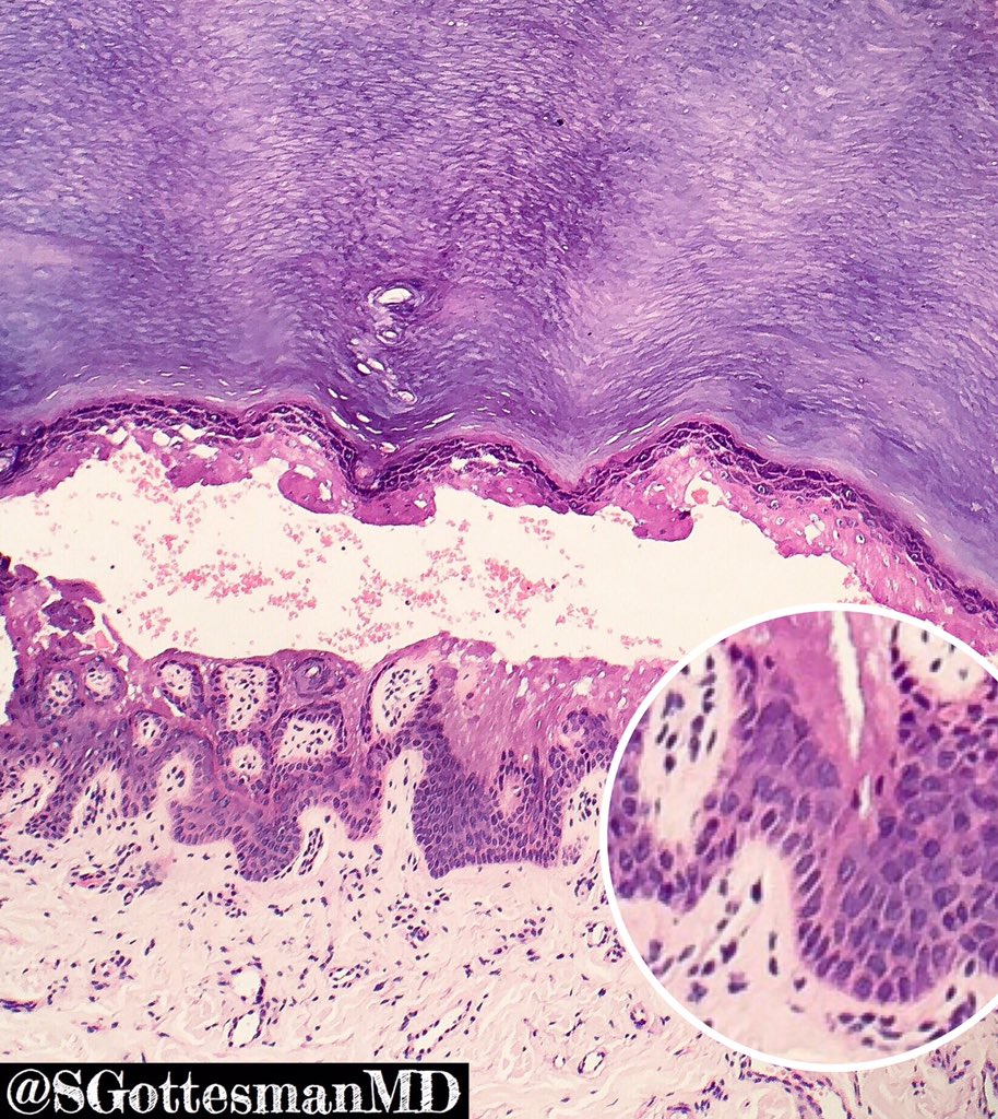 Confluent And Reticulated Papillomatosis Pathology