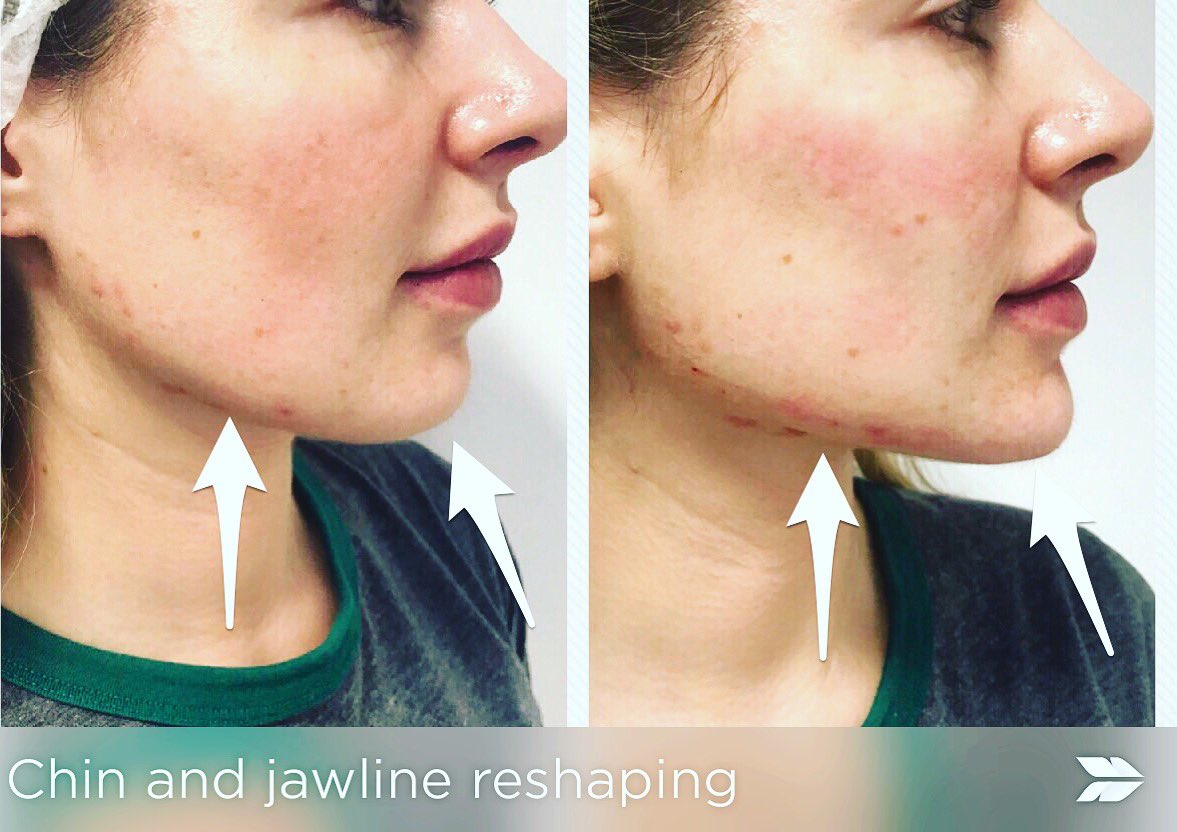 Weak Jawline Examples