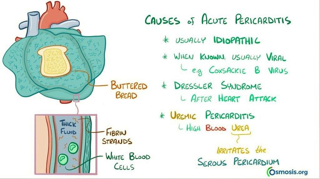 Constrictive Pericarditis Pathology