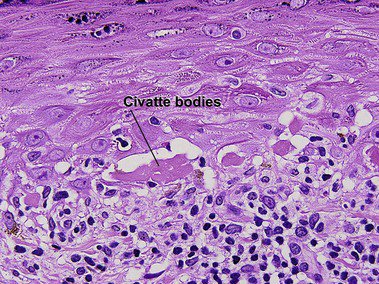 Lichen Planus Histology Civatte Body