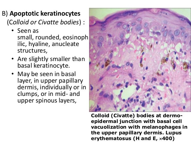 Civatte Bodies Lichen Planus