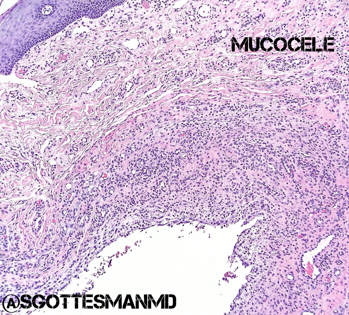 Mucocele Histology