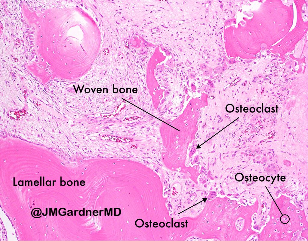 Bone Remodeling Histology Bone Remodeling Histology