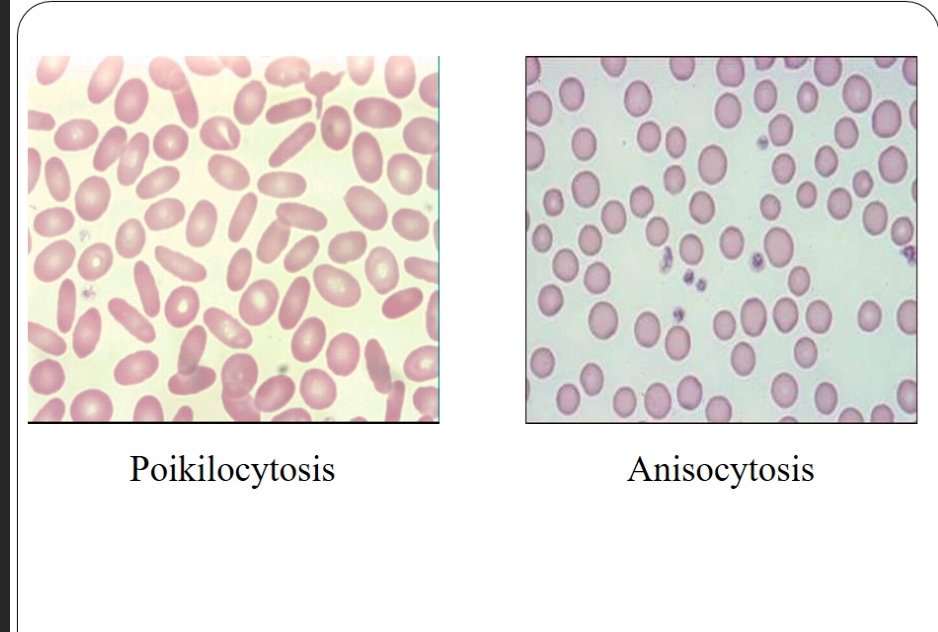 Anisocytosis