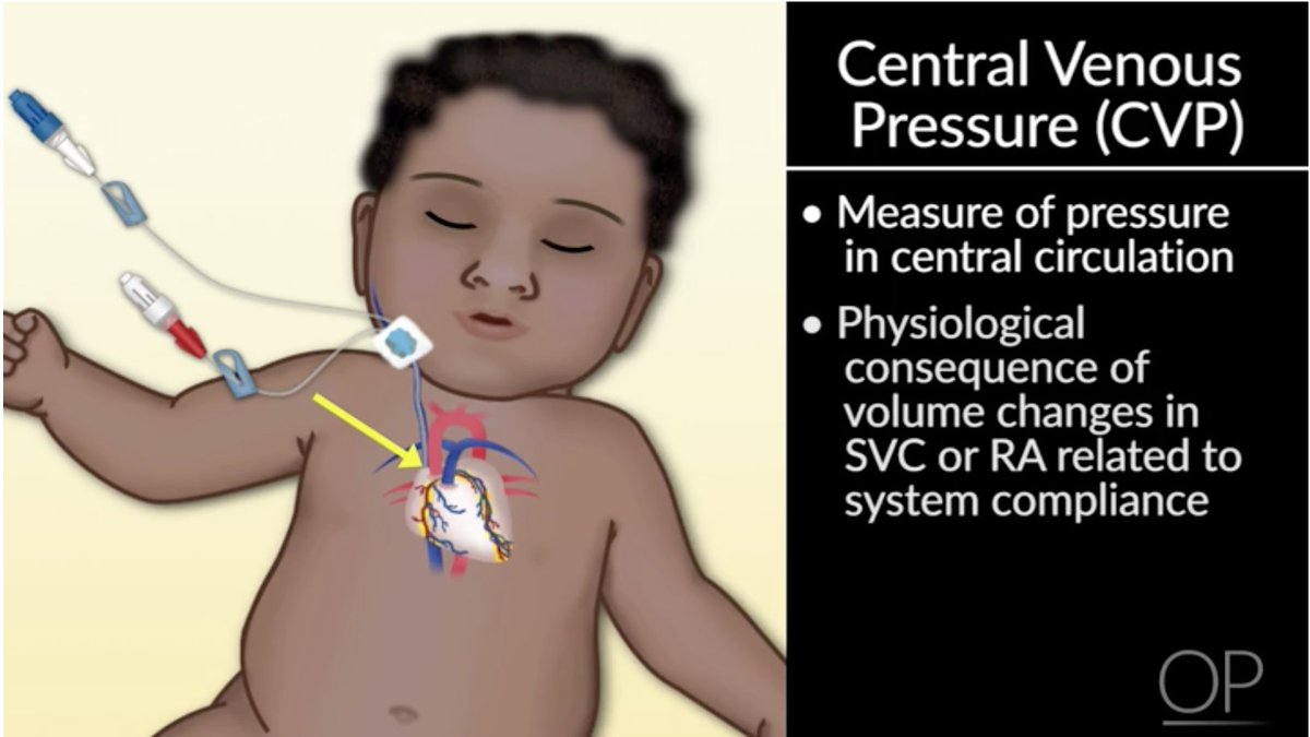 Measuring Central Venous Pressure