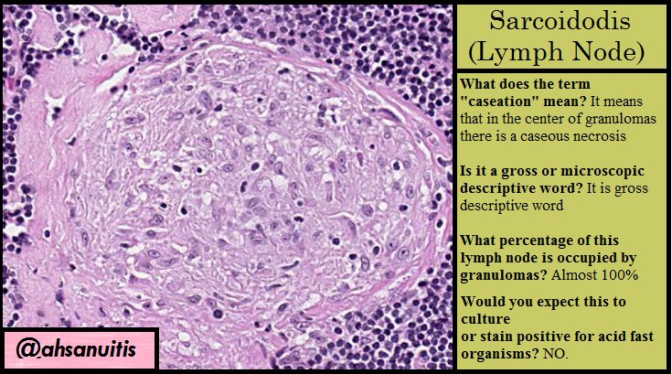 Sarcoidosis Histology