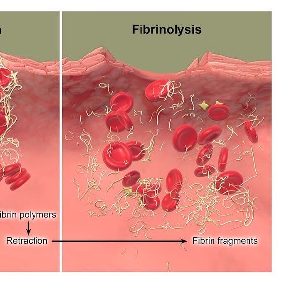 Fibrinolysis