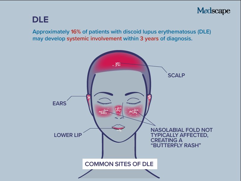 Discoid Lupus Erythematosus Seal
