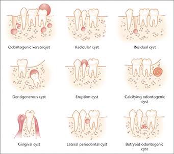 Botryoid Odontogenic Cyst