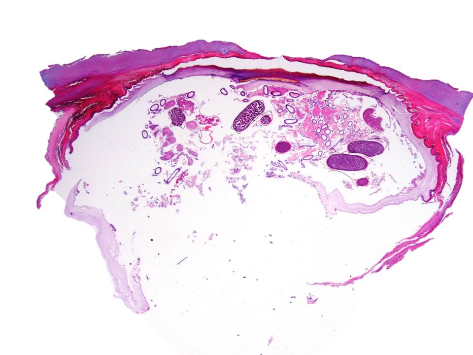 Tunga Penetrans Histology