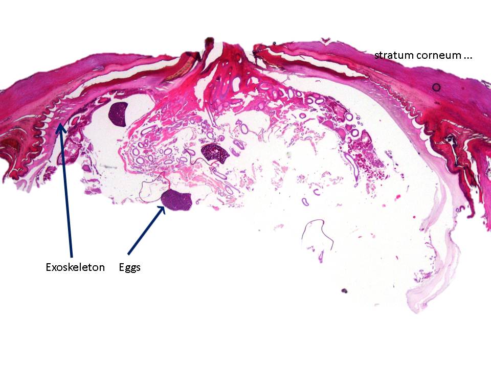 Tunga Penetrans Histology