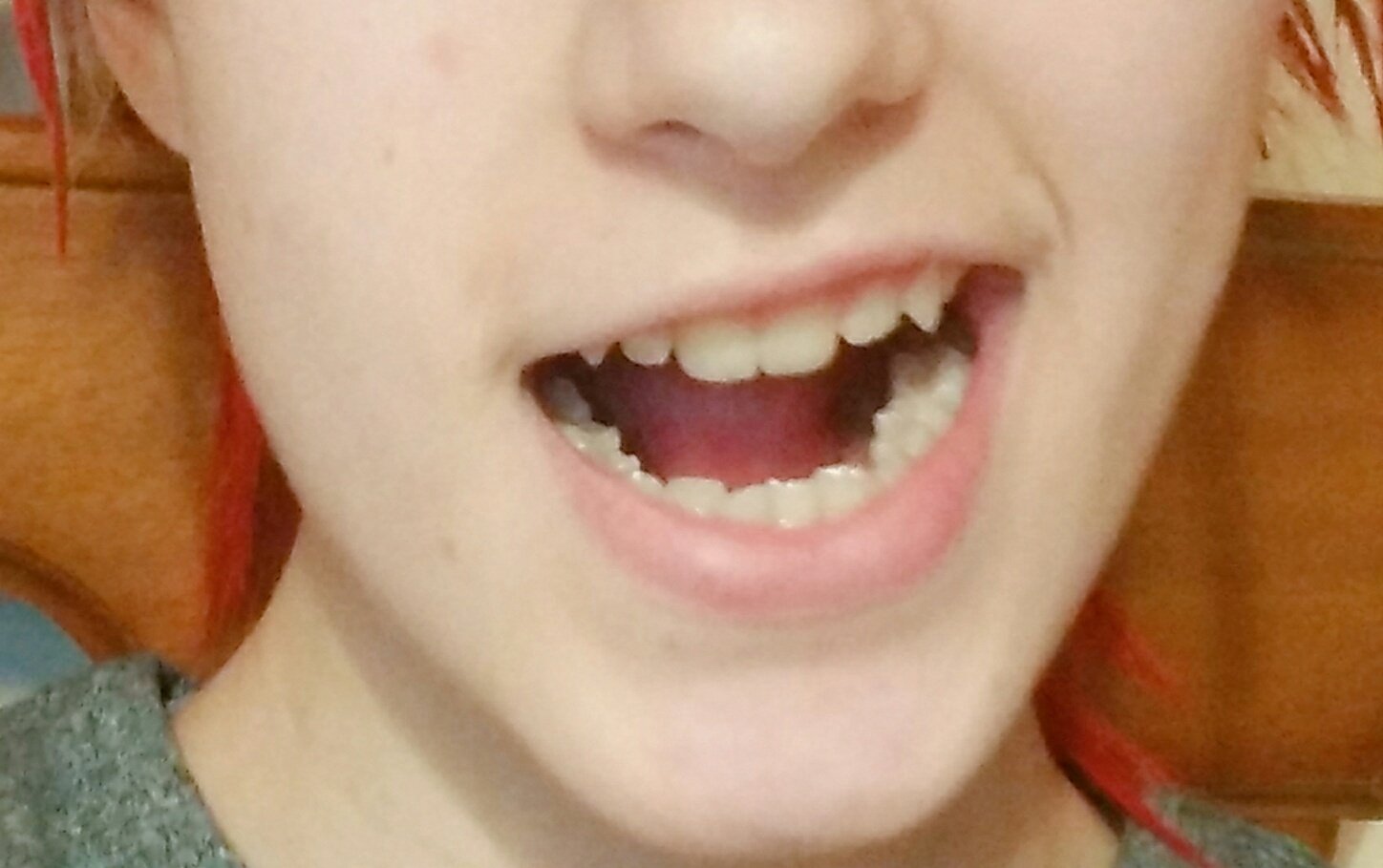 People With Sharp Canine Teeth