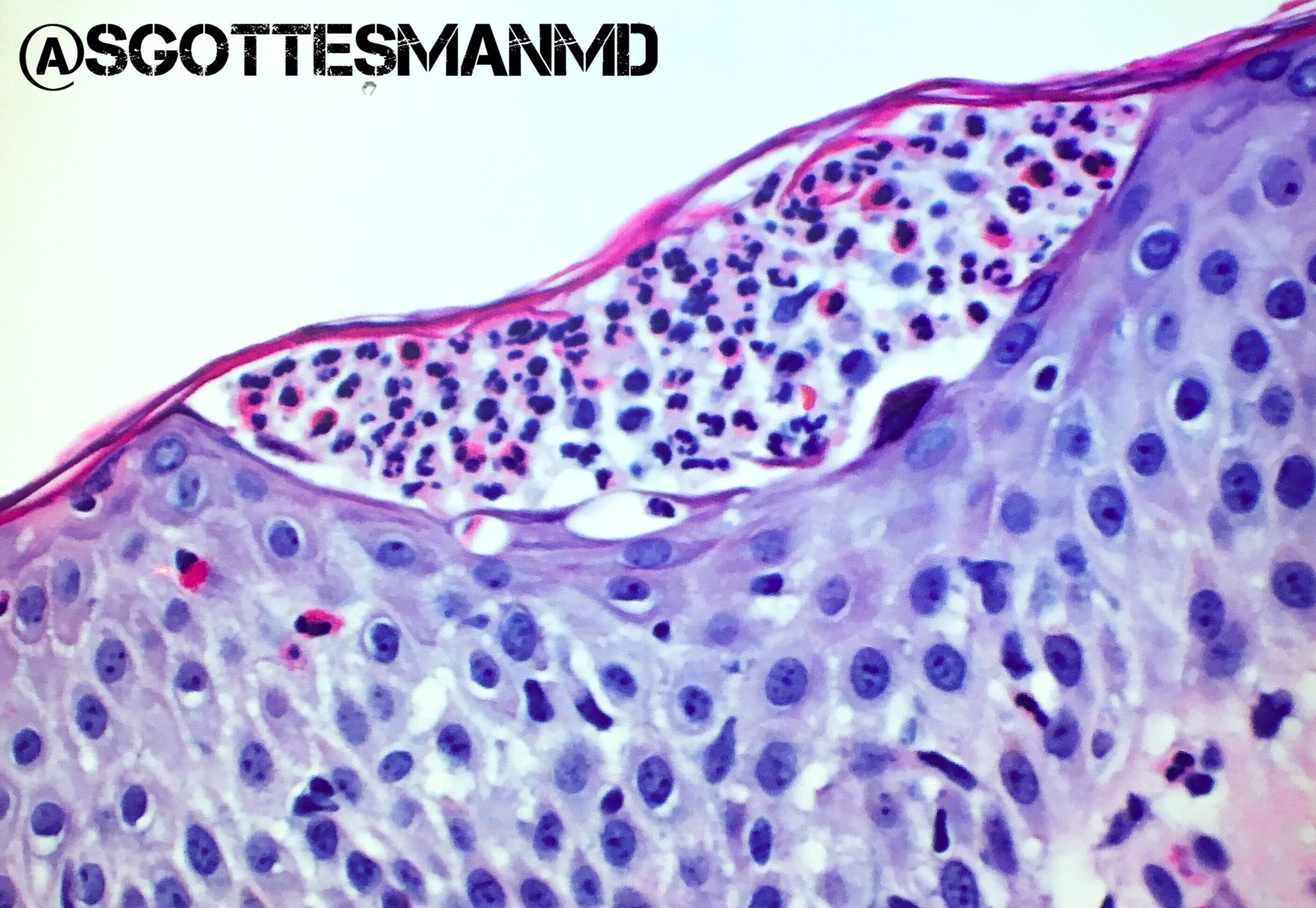 Acute Generalized Exanthematous Pustulosis Histology