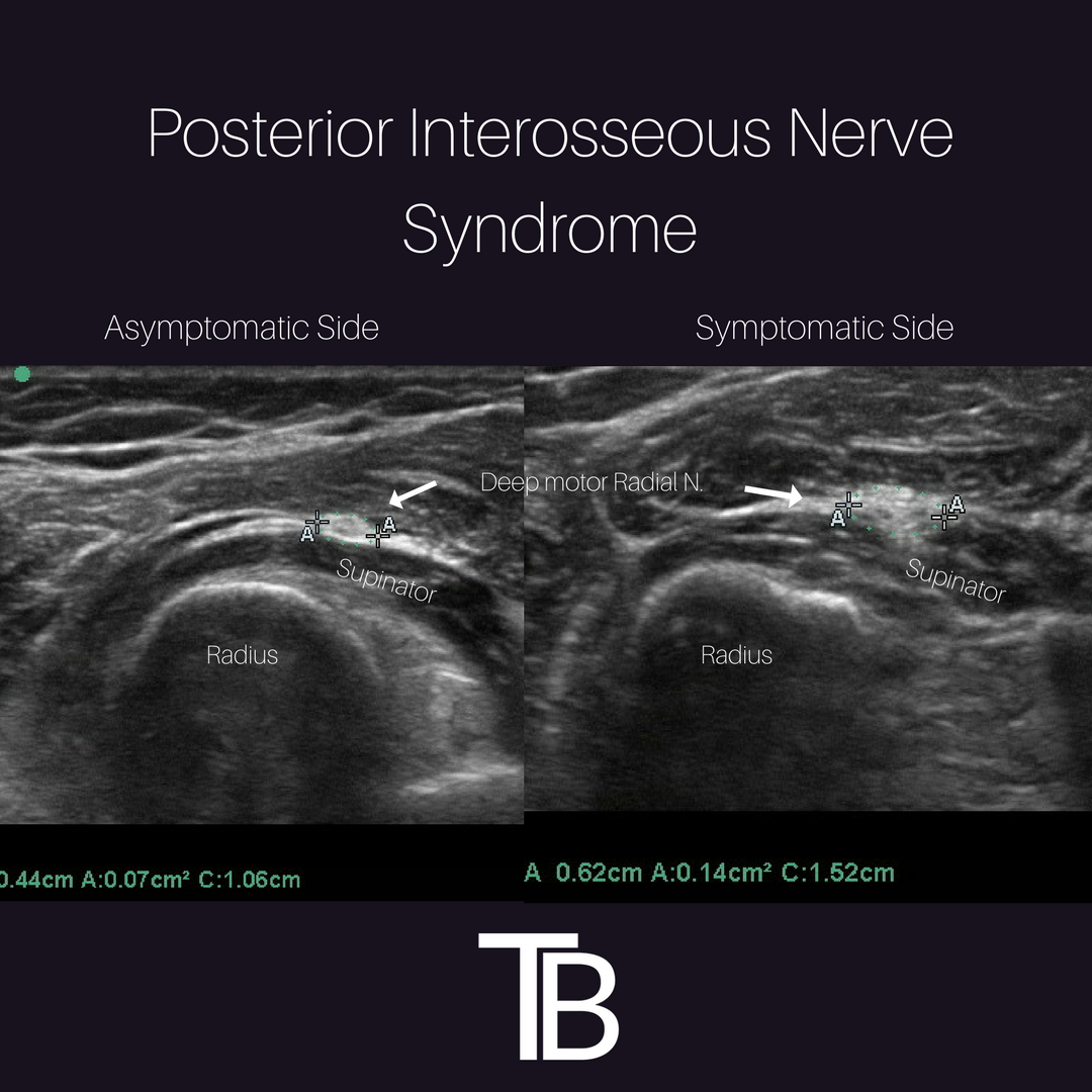 Posterior Interosseous Nerve