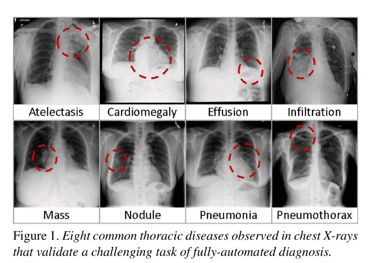 Lung Cancer Vs Normal Chest X Ray