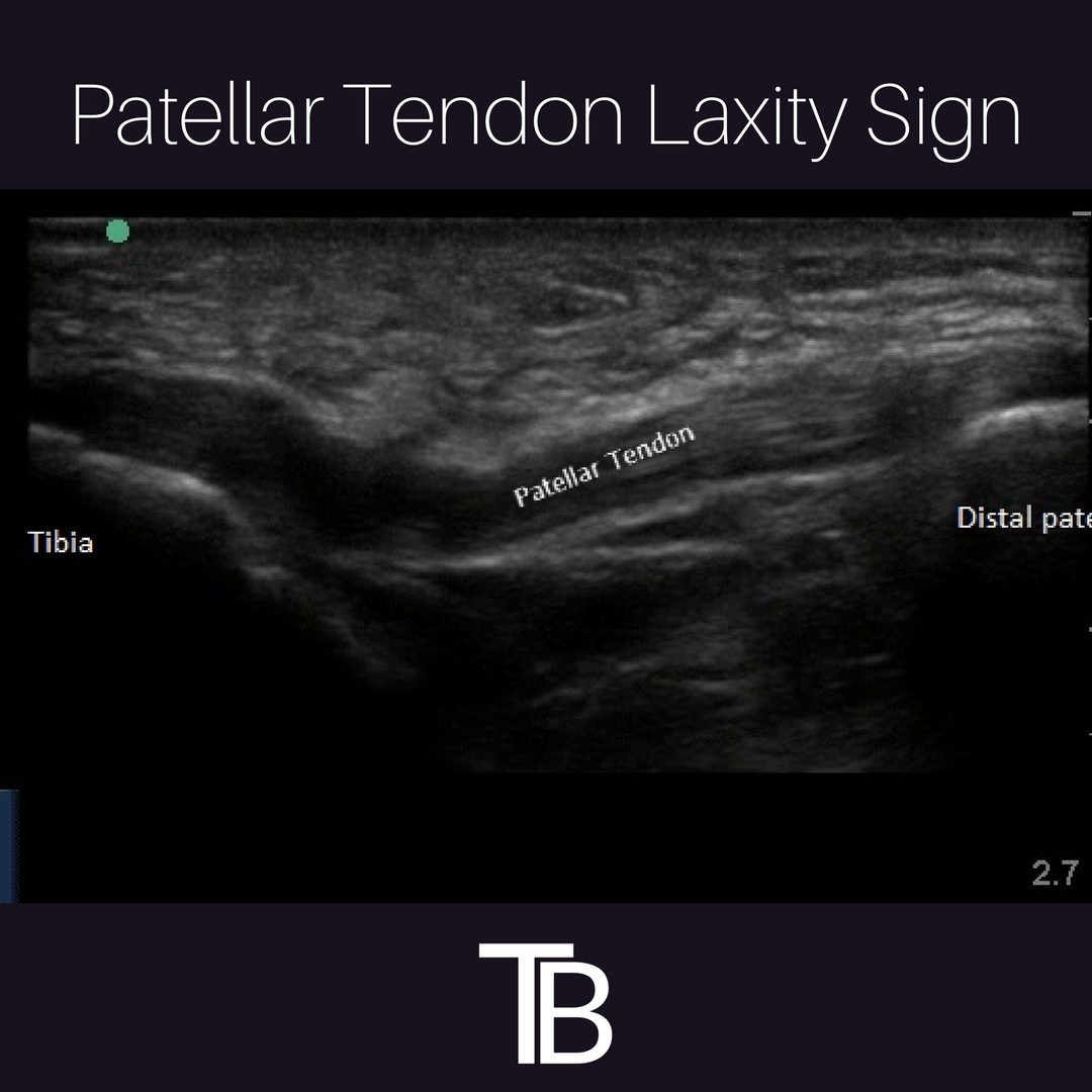 Quadriceps Tendon Ultrasound