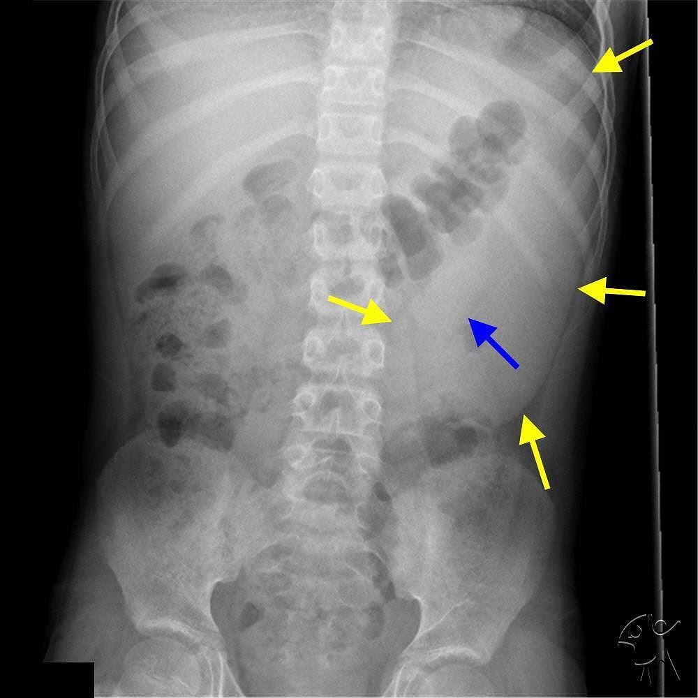 Enlarged Spleen In Kids