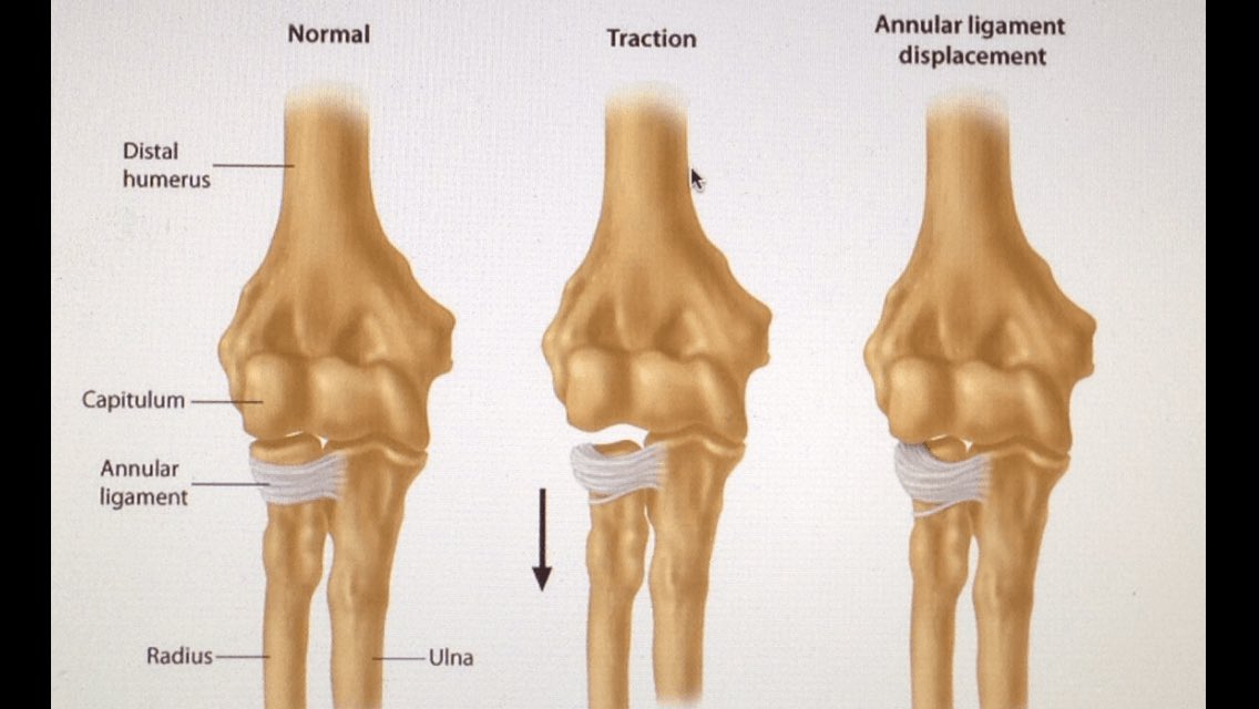 Head Of Radius Annular Ligament