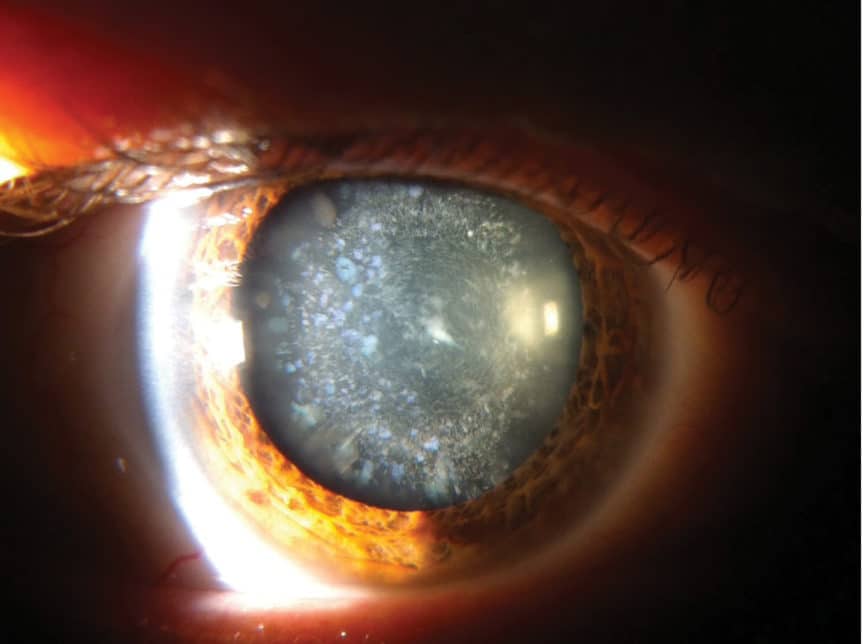 Blue Dot Cataract