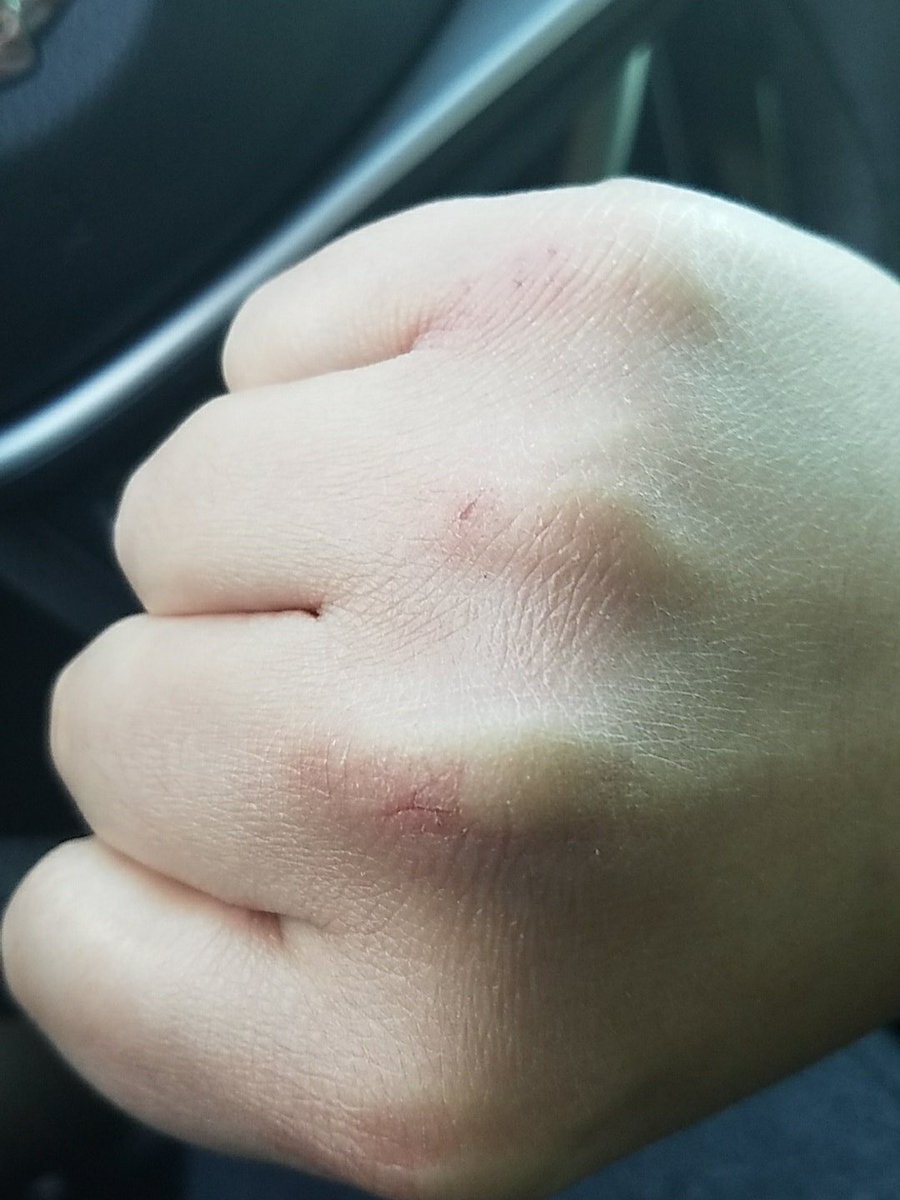 Bruised Knuckles After Boxing