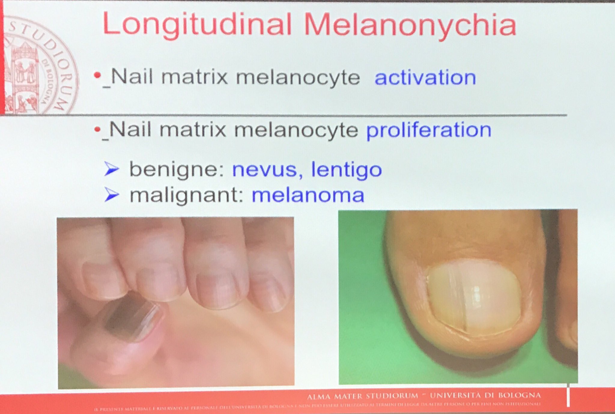 Melanocytic Nevus Nail