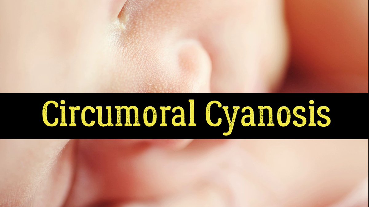 Circumoral Cyanosis