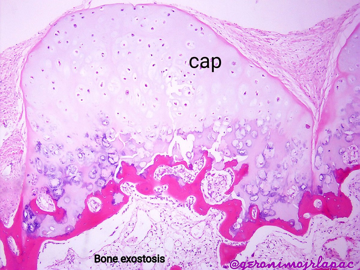 Osteochondroma Histology