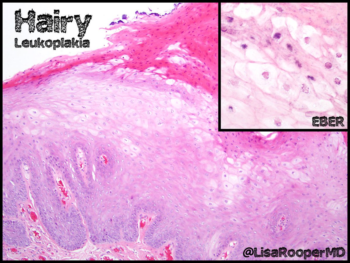 Hairy Leukoplakia Histology Oral Proliferative Verrucous Leukoplakia: