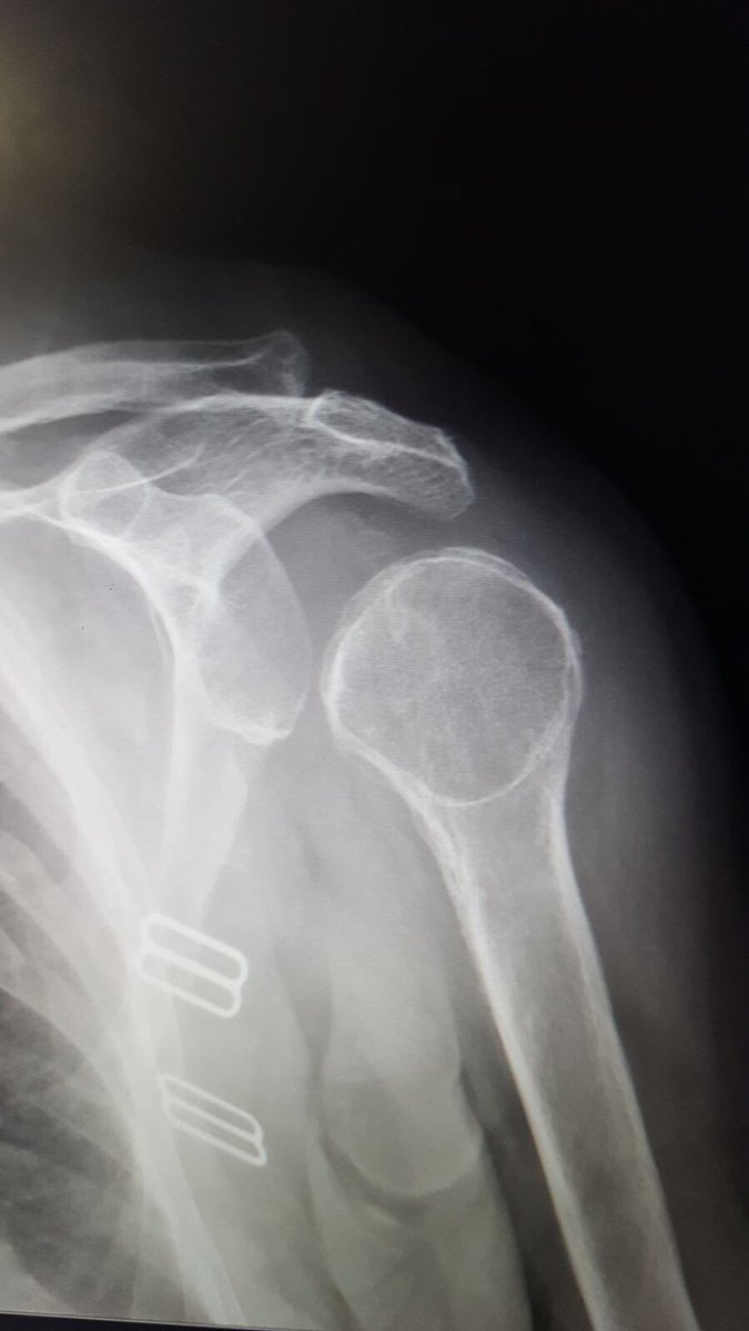 Radiografía De Hombro De Rotación Externa