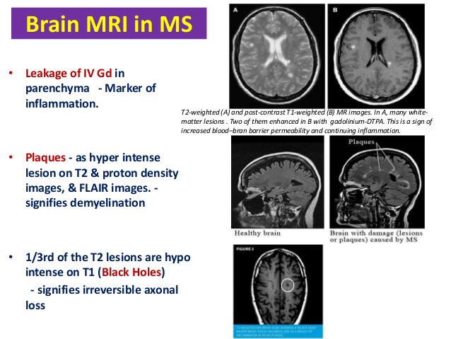 Ms Brain Mri With Contrast