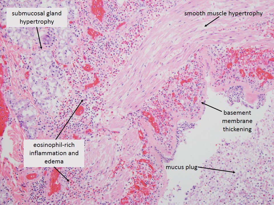 Asthma Histology