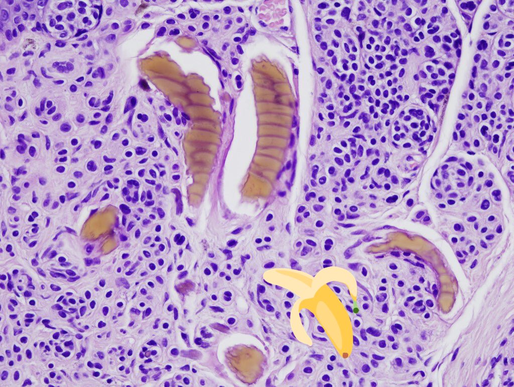 Ochronosis Histology
