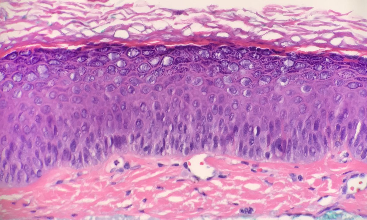 Verruca Plana Histopathology Verrucous Plaques On Sun Exposed Areas