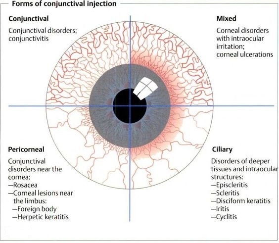 Limbic Sparing Conjunctivitis