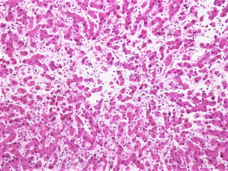 Nutmeg Liver Histology