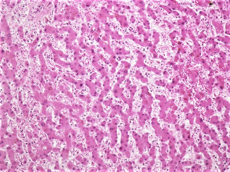 Nutmeg Liver Histology