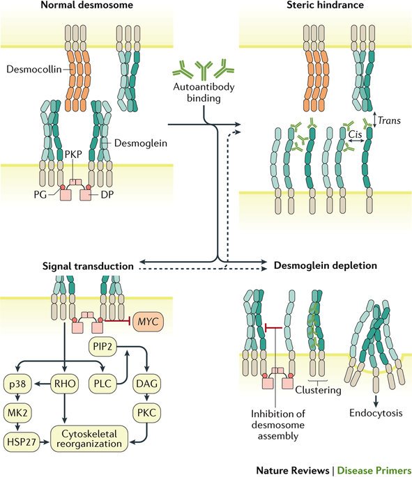 Acantholysis